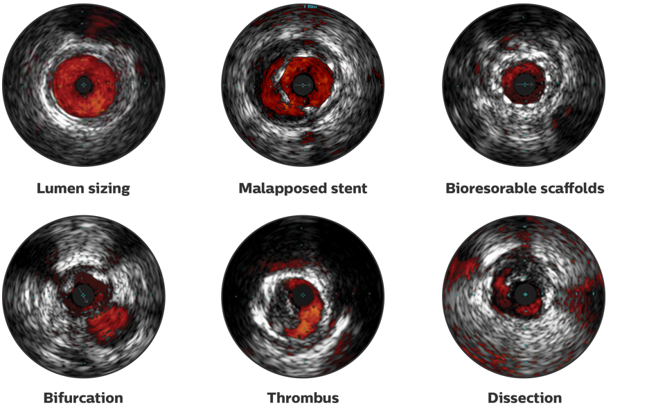 Philips Volcano ChromaFlo imaging | Philips Healthcare