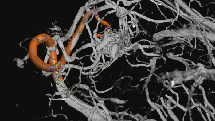 AVM treatment | Philips