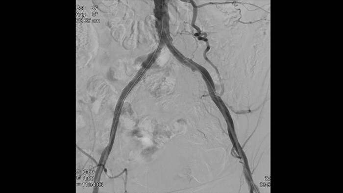 Aortic disease | Philips