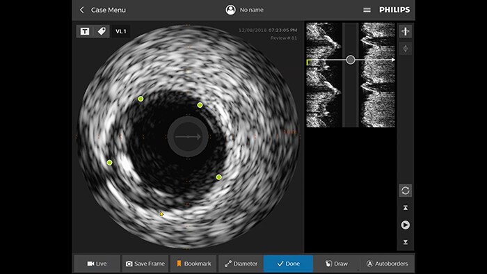 IntraSight Interventional Applications Platform | Philips Healthcare